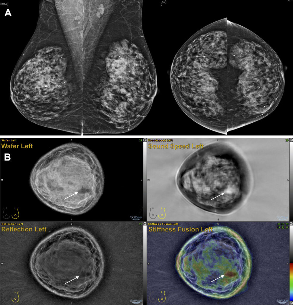 US Tomo for Dense Breasts - The Imaging Wire